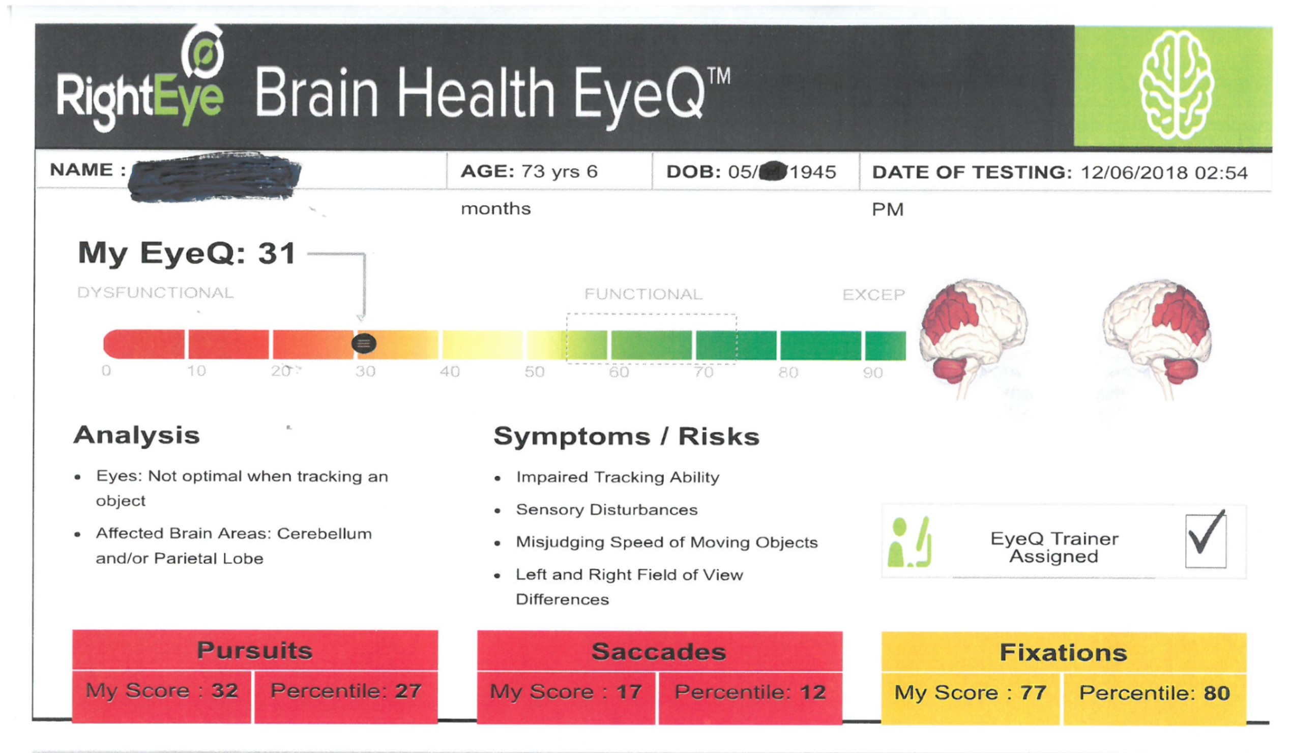 Eye Exercises For Concussion & Whiplash Rehab - Scottsdale Chiropractor ...